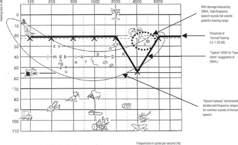 What is Noise-Induced Hearing Loss (NIHL)?