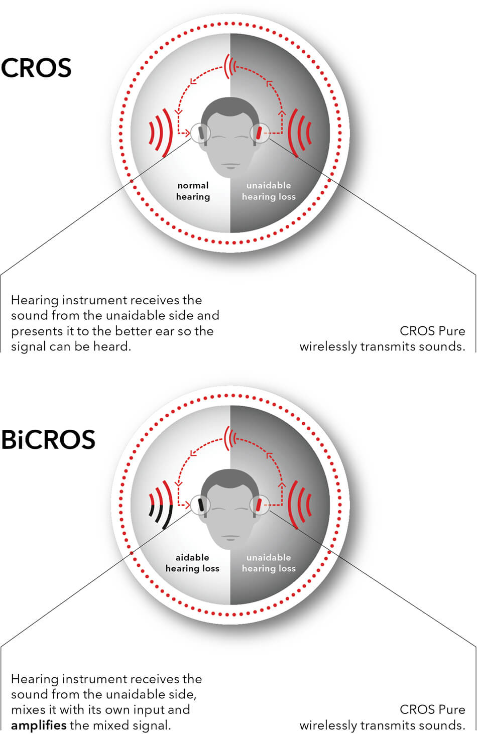 What Is Unilateral Hearing Loss aka Single Sided Deafness